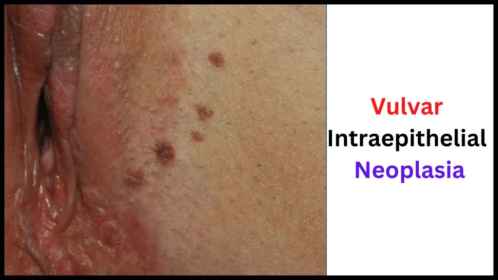 What Are The Warning Signs Of Vulvar Cancer - Ultimate Guide